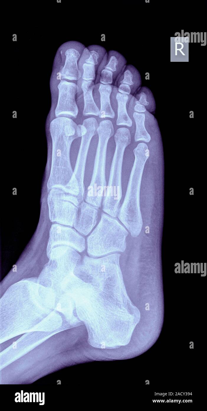 x-ray of a foot showing a fracture in the 5th metatarsalia of a 31 year ...