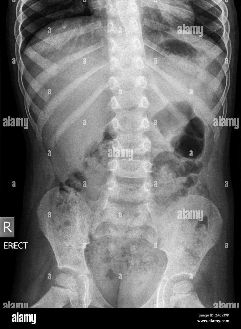 Abdomen x-ray of a standing 5 year old male child Stock Photo - Alamy