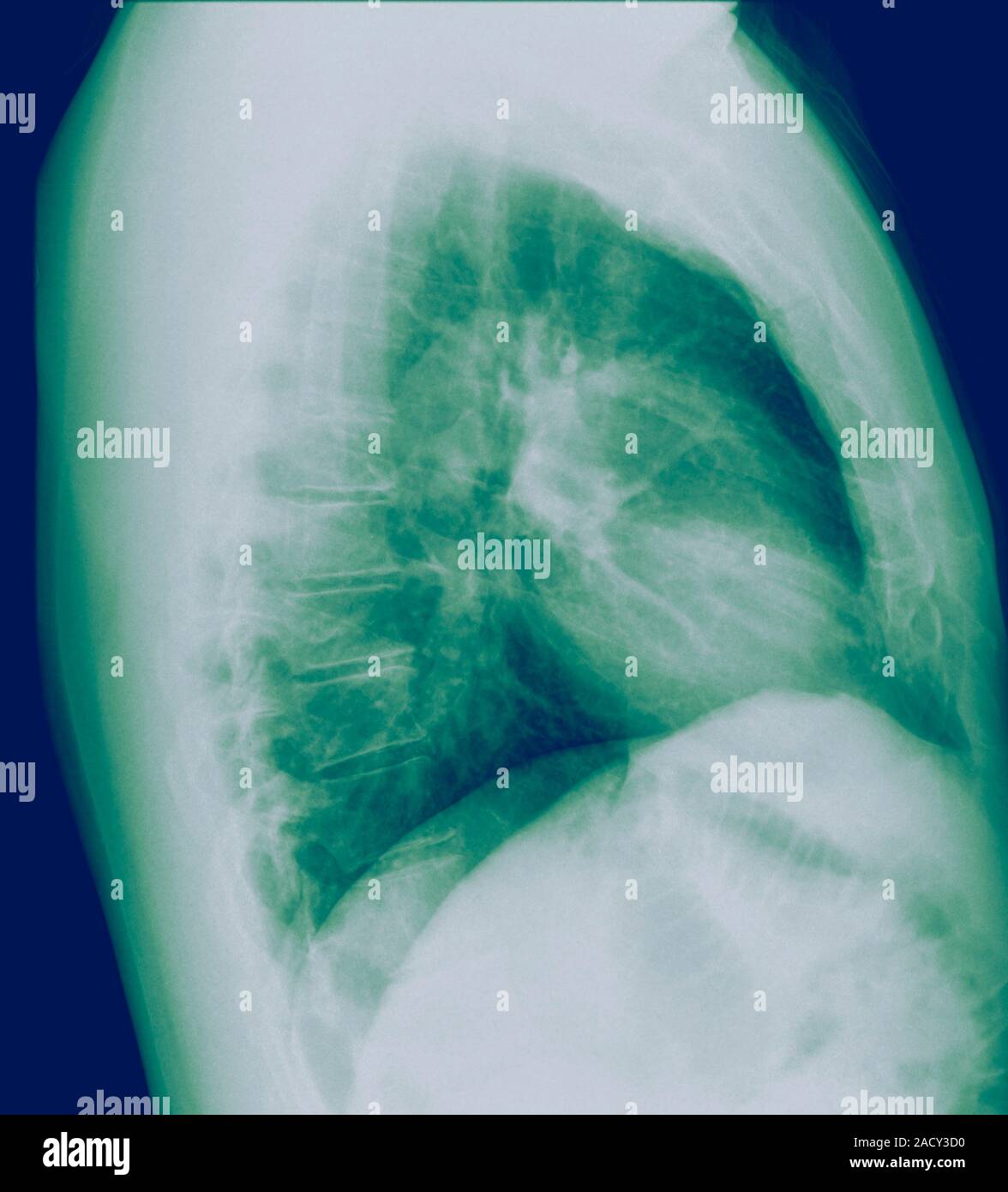 Normal Healthy Chest x-ray of a 46 year old male. side view Stock Photo ...