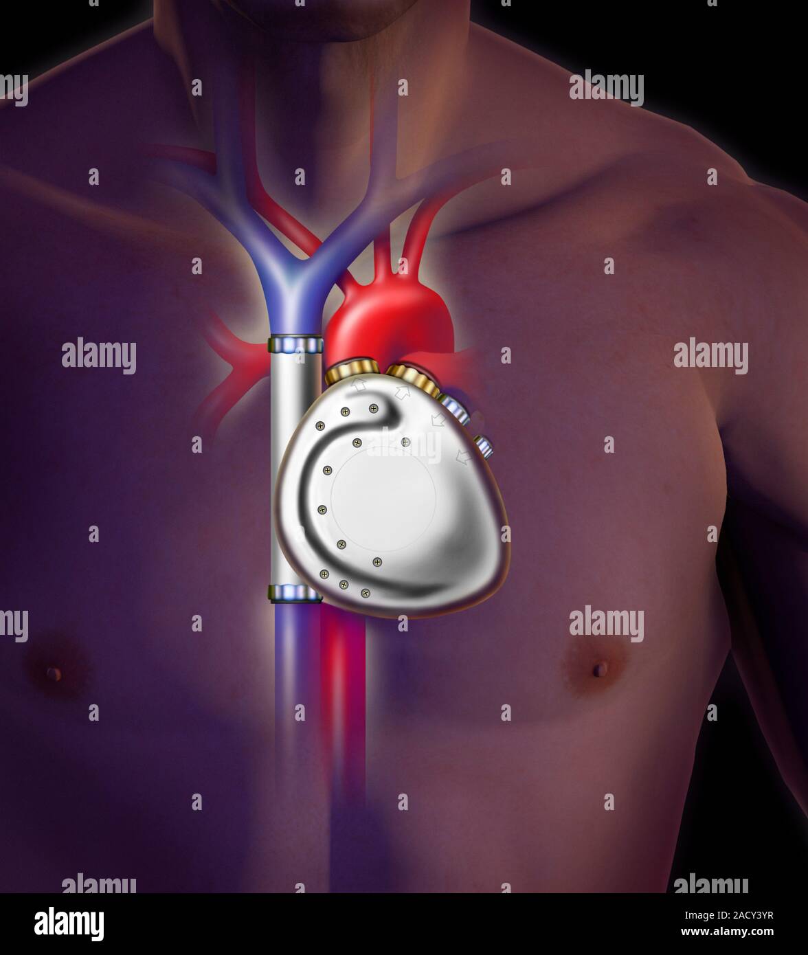 Artist's impression of a mechanical heart pump in a human body ...