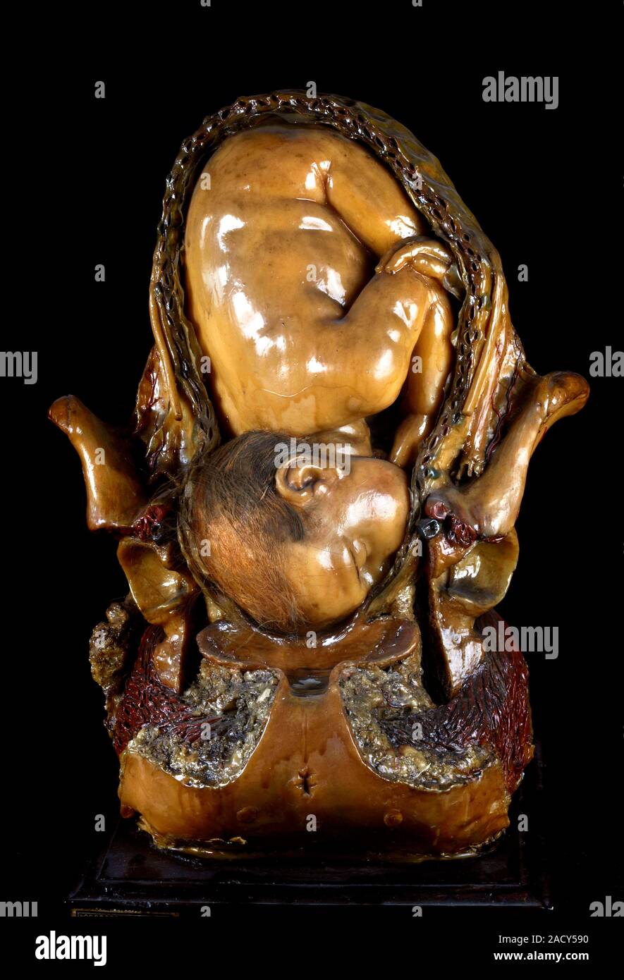 Pregnancy model. 18th-century wax and wood model of a foetus close to ...