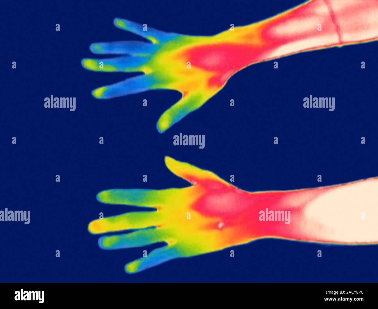 Thermogram of the hands of a 38 year old female. The temperature scale ...