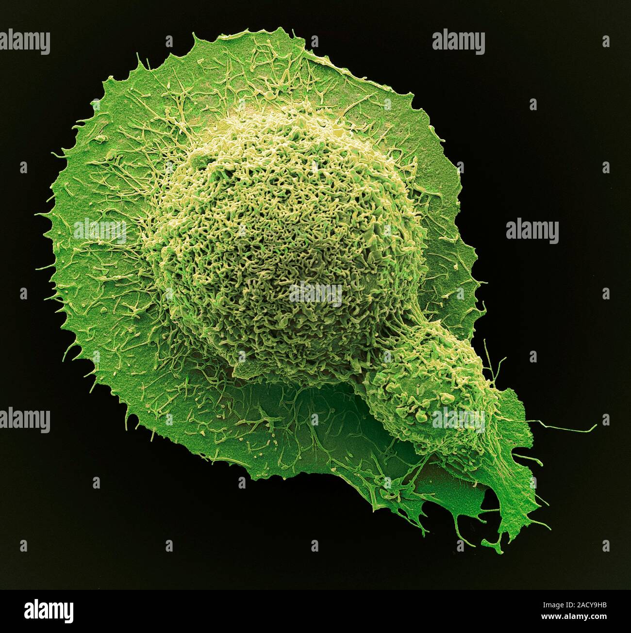Colorectal Cancer Cell Coloured Scanning Electron Micrograph Sem Of