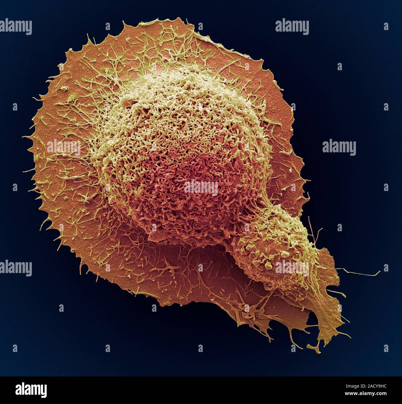 Colorectal cancer cell. Coloured scanning electron micrograph (SEM) of ...