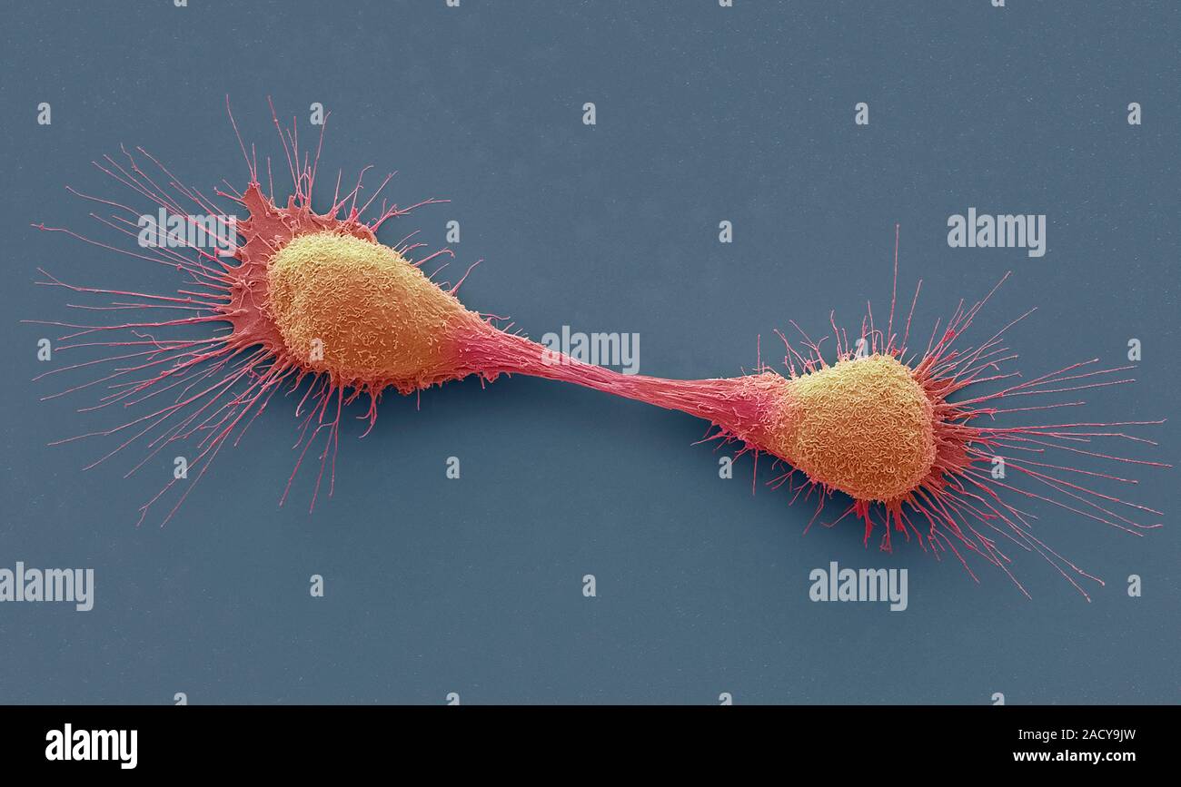 Dividing prostate cancer cells, Coloured scanning electron micrograph ... Dividing prostate cancer cells, Coloured scanning electron micrograph ...