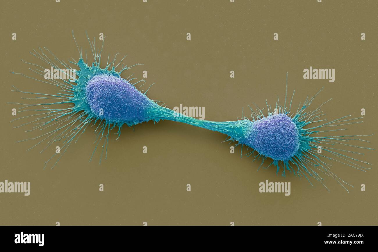 Dividing prostate cancer cells, Coloured scanning electron micrograph ...