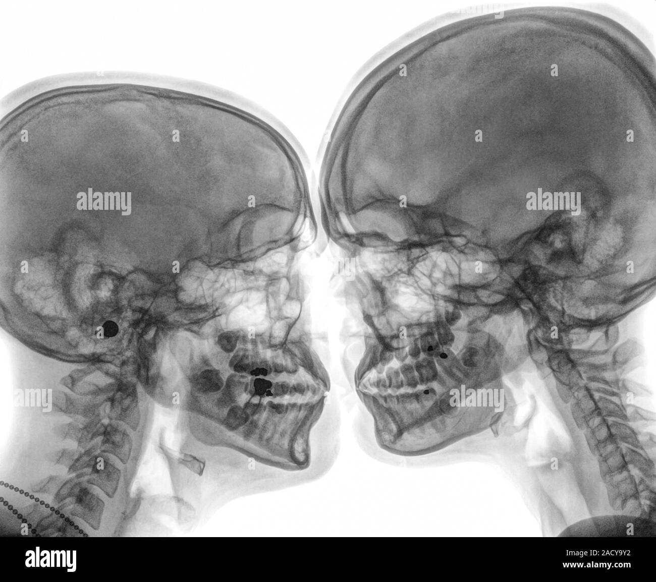 Kissing Couple. Two people kissing under x-ray Stock Photo - Alamy