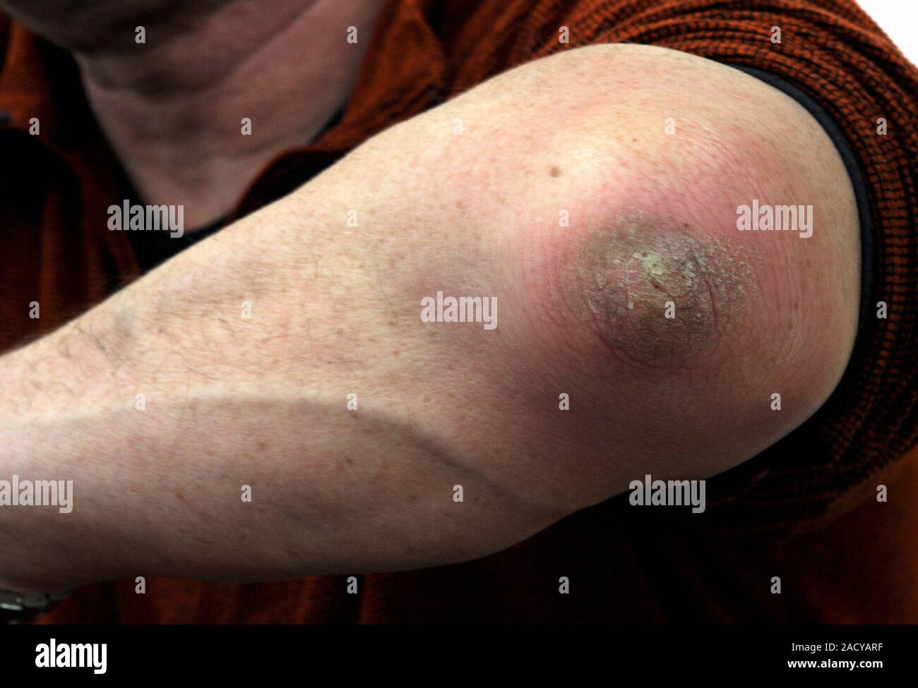 Not for use in Television Not for use in Television Infected olecranon ...