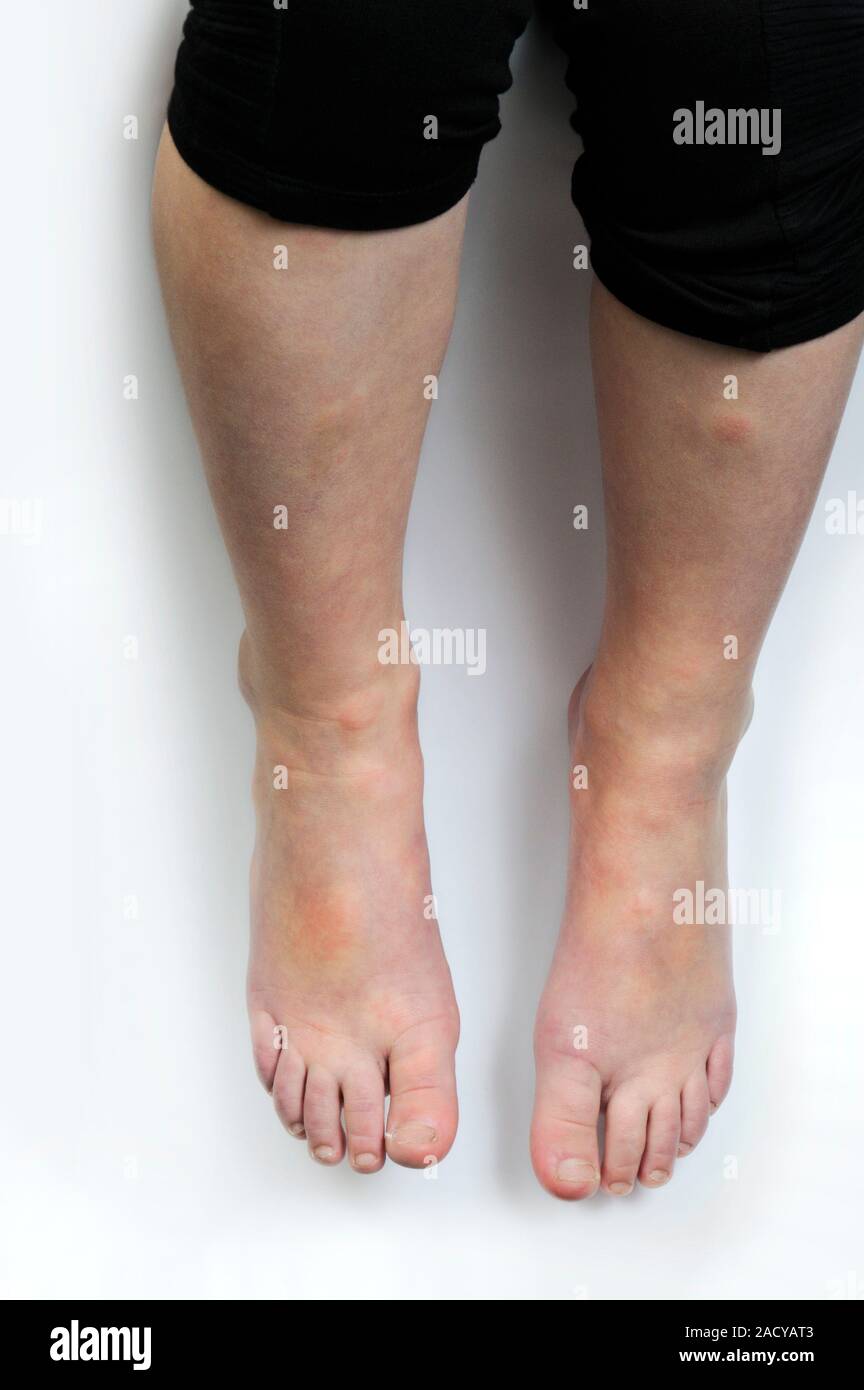 Not for use in Television Not for use in Television Urticaria on legs ...