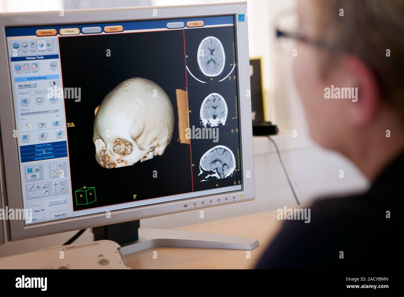 CT scanning. Radiologist examining CT (computed tomography) scans of ...