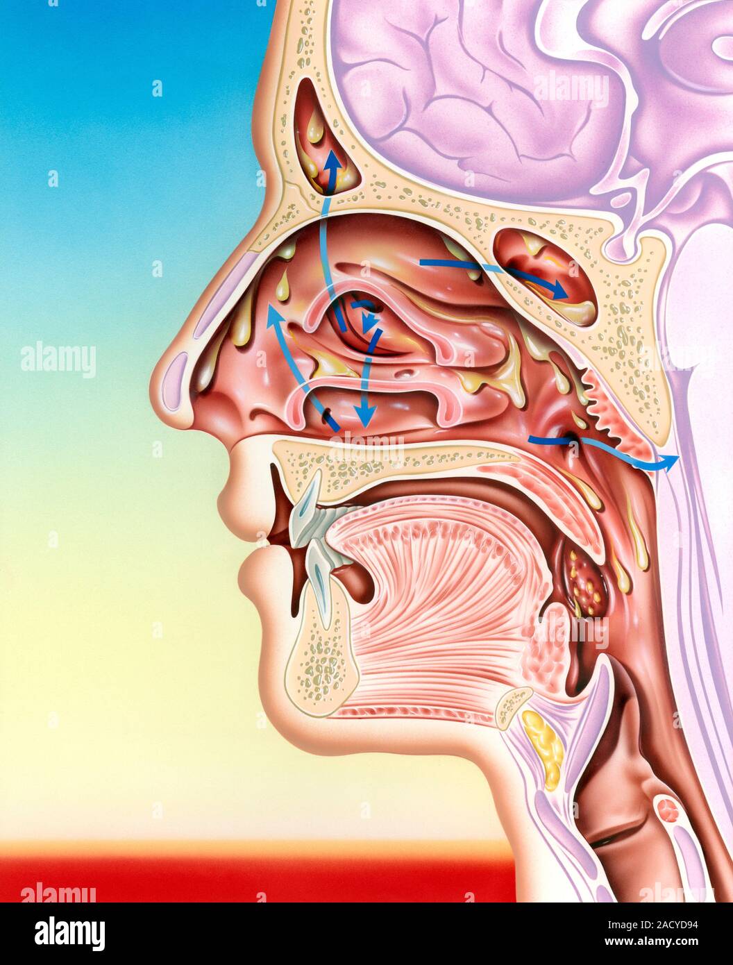 Upper respiratory tract infection. Artwork of a sectioned side view of ...