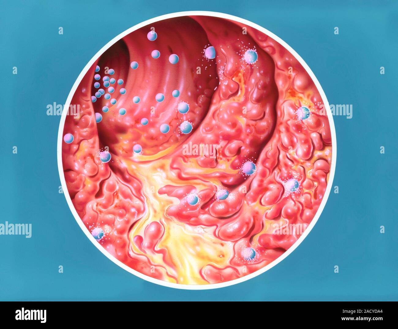 Ulcerative colitis treatment. Artwork showing the large intestine ...