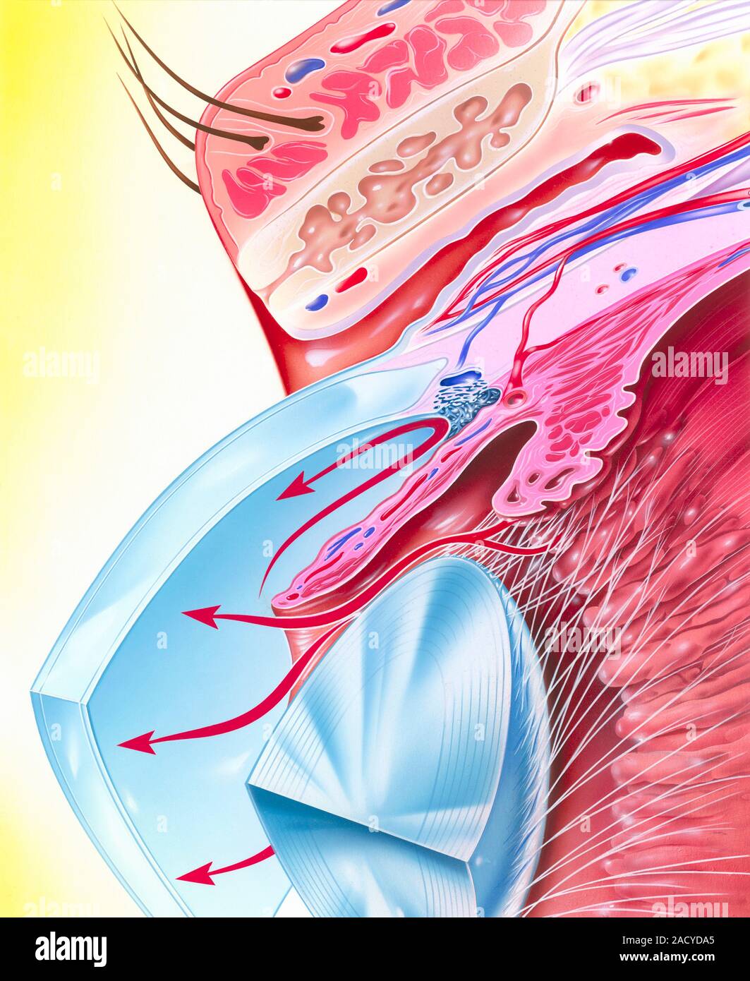 Glaucoma. Artwork showing the flow of aqueous humour (red arrows) in ...