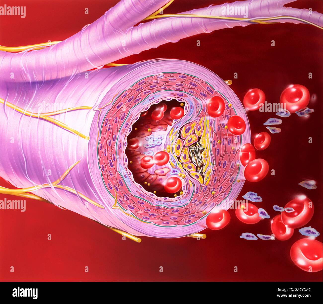 Atherosclerosis of artery. Artwork of a cross-section through an artery ...