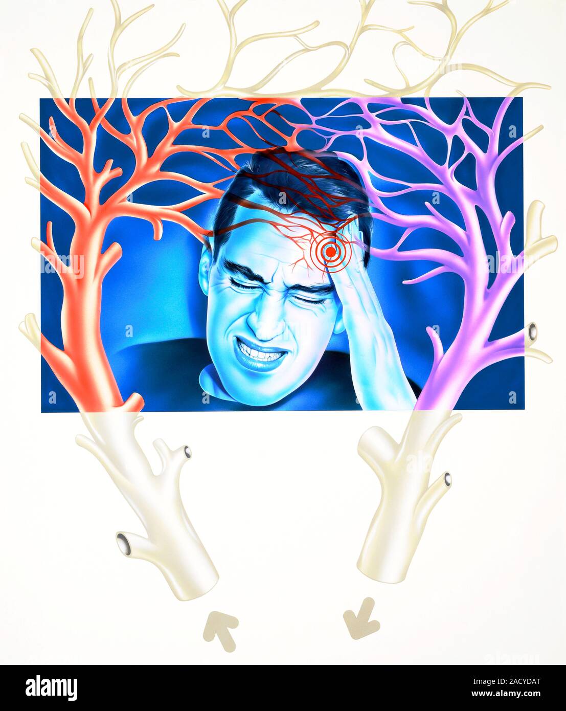 Migraine. Artwork of the blood vessels leading to and from the brain ...