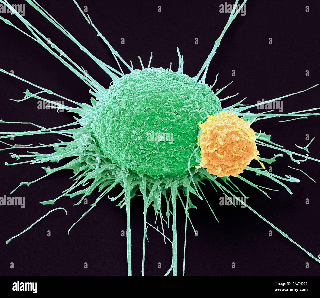 T lymphocyte and prostate cancer cell. Coloured scanning electron ...