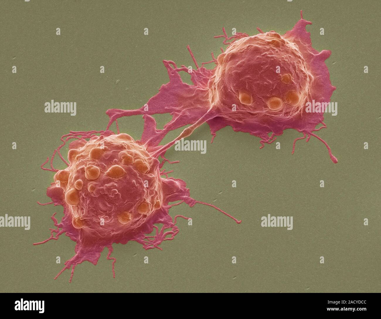 Colorectal cancer cells. Coloured scanning electron micrograph (SEM) of ...