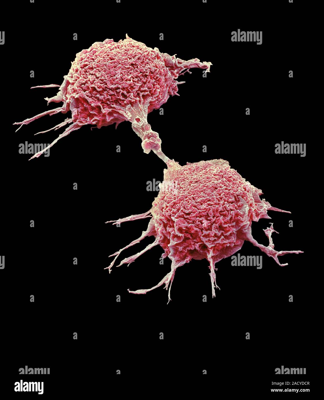 Lung cancer cell. Coloured scanning electron micrograph (SEM) of ...