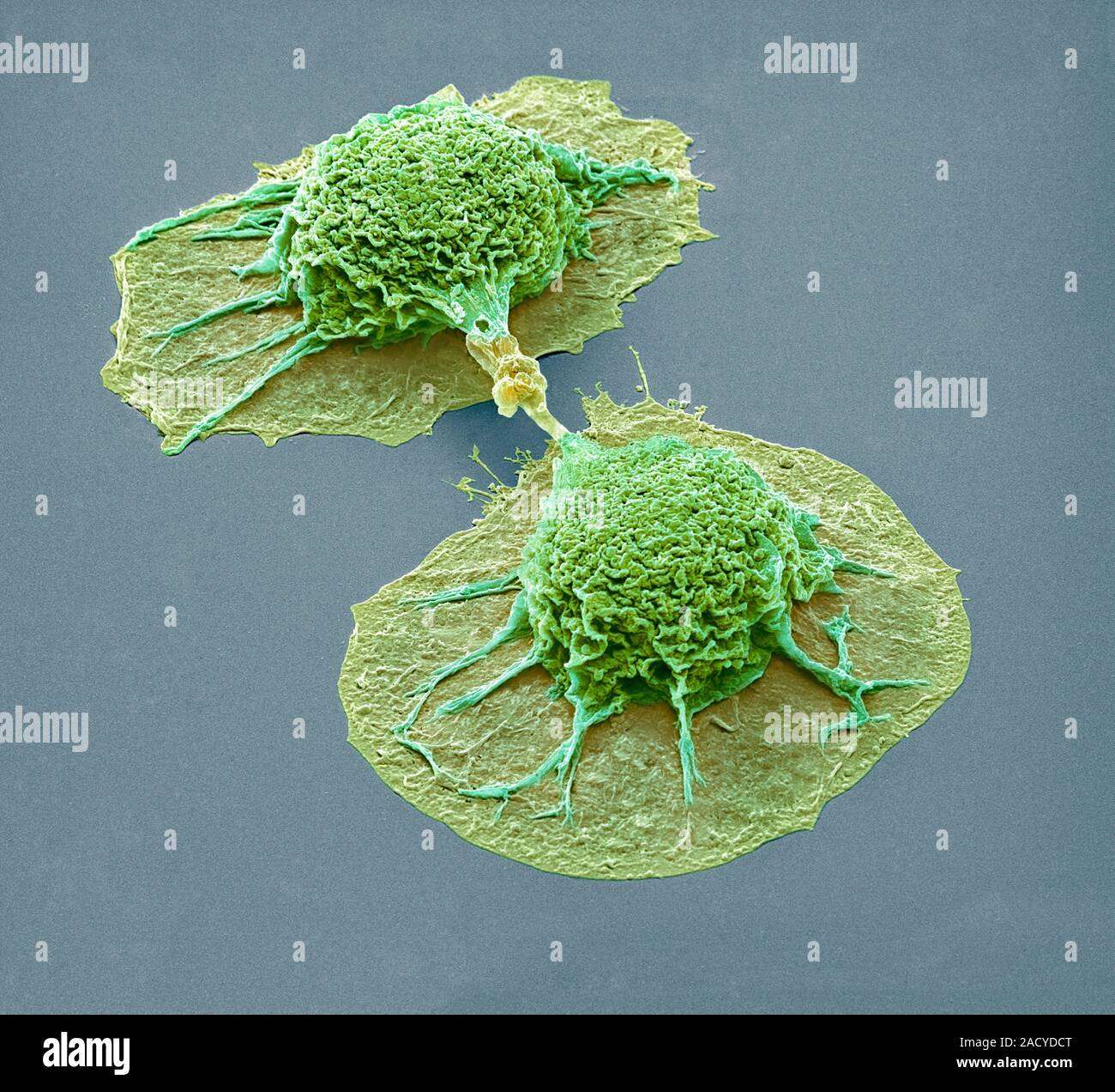 Lung cancer cell. Coloured scanning electron micrograph (SEM) of ...