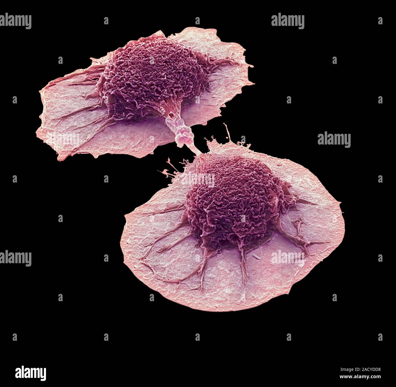 Lung cancer cell. Coloured scanning electron micrograph (SEM) of ...