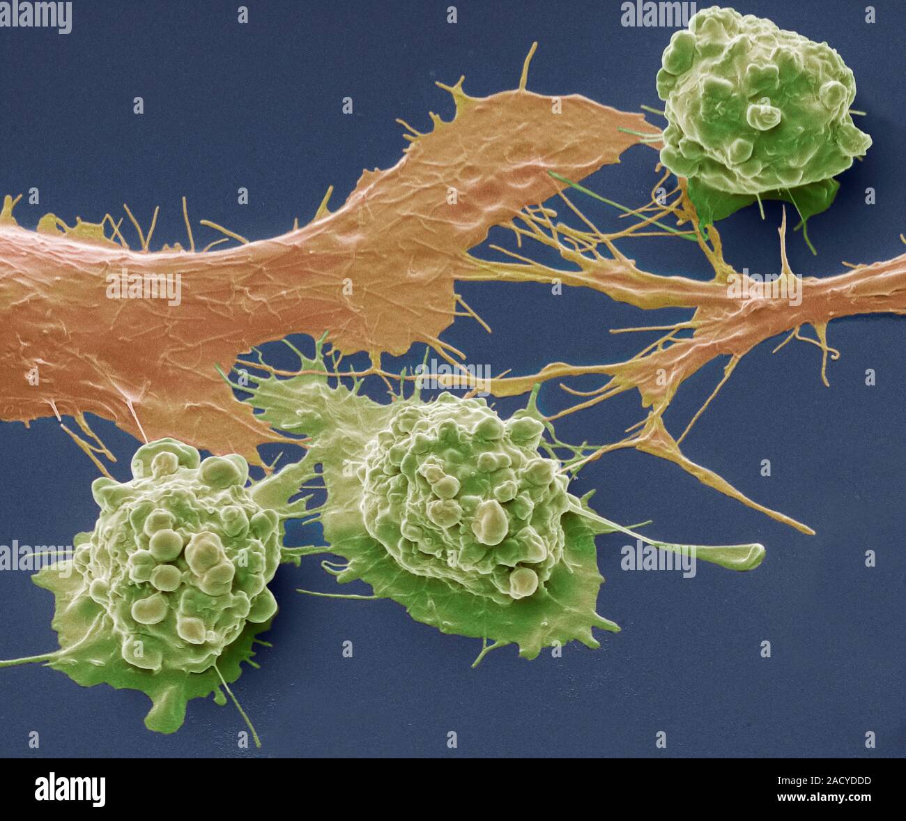 Colorectal cancer cells. Coloured scanning electron micrograph (SEM) of ...