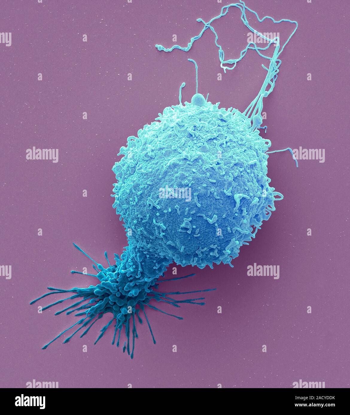 Prostate cancer cell, Coloured scanning electron micrograph (SEM). Such ...
