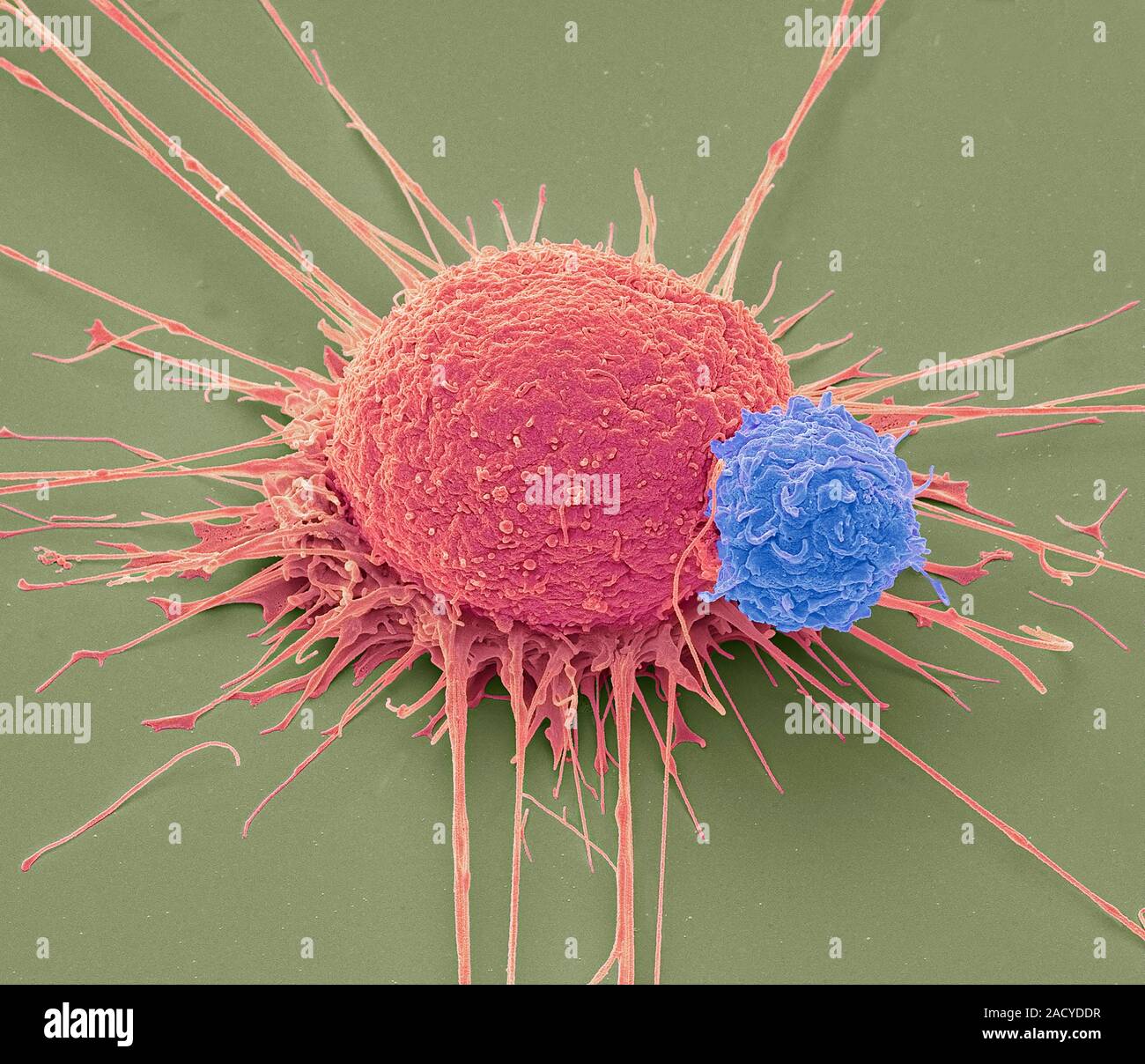 T lymphocyte and prostate cancer cell. Coloured scanning electron ...