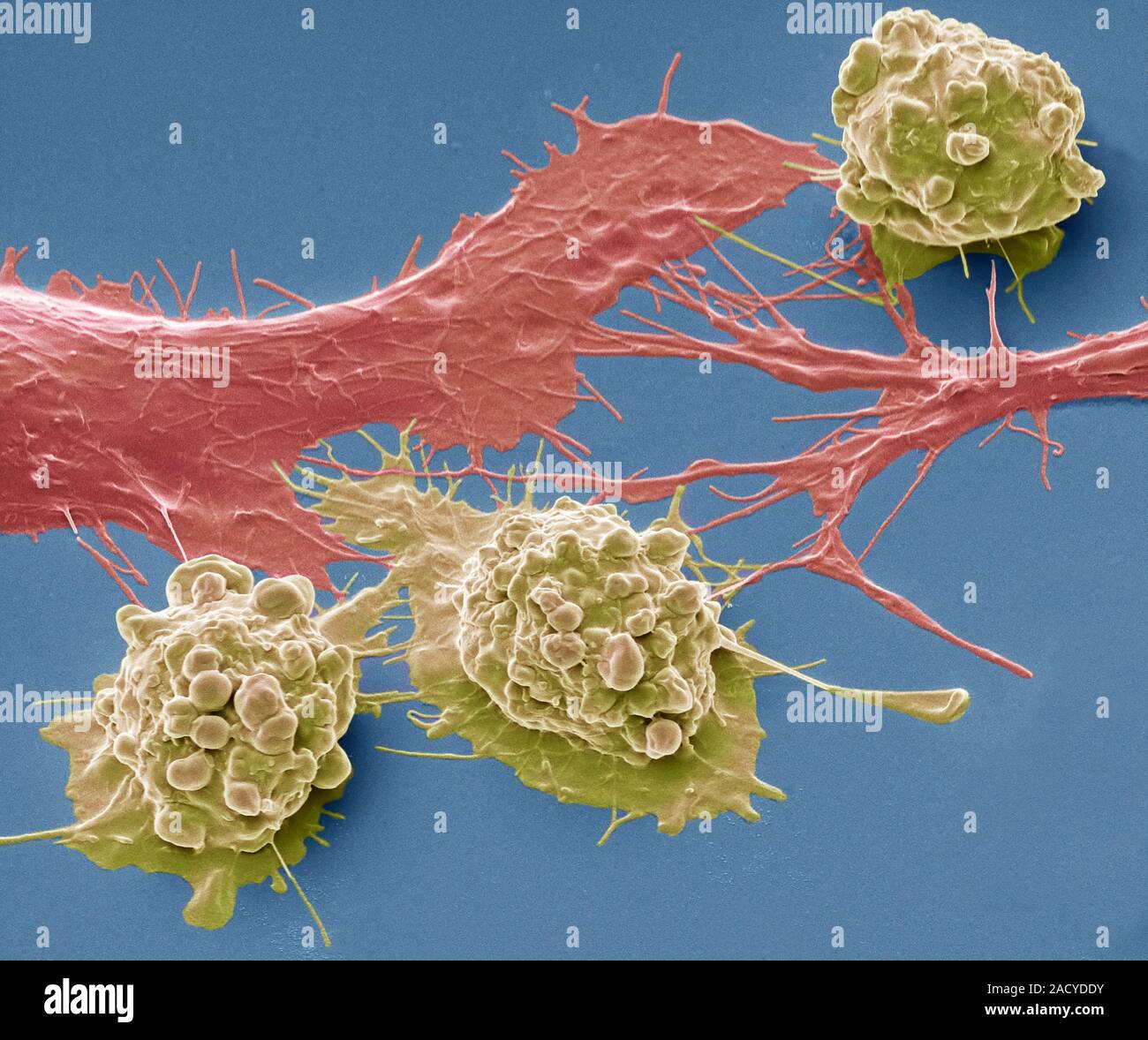 Colorectal cancer cells. Coloured scanning electron micrograph (SEM) of ...