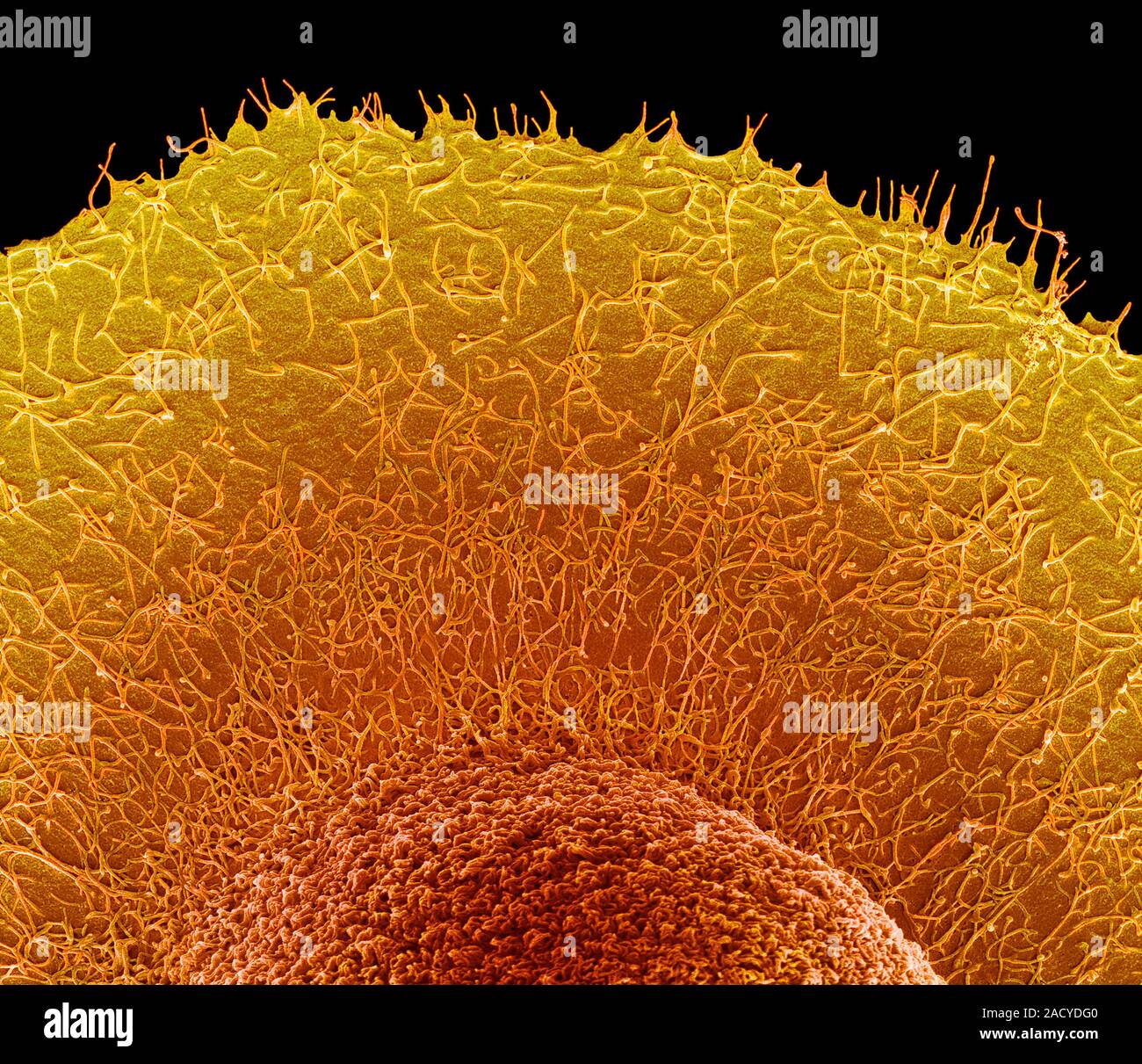 Colorectal cancer cell. Coloured scanning electron micrograph (SEM) of ...