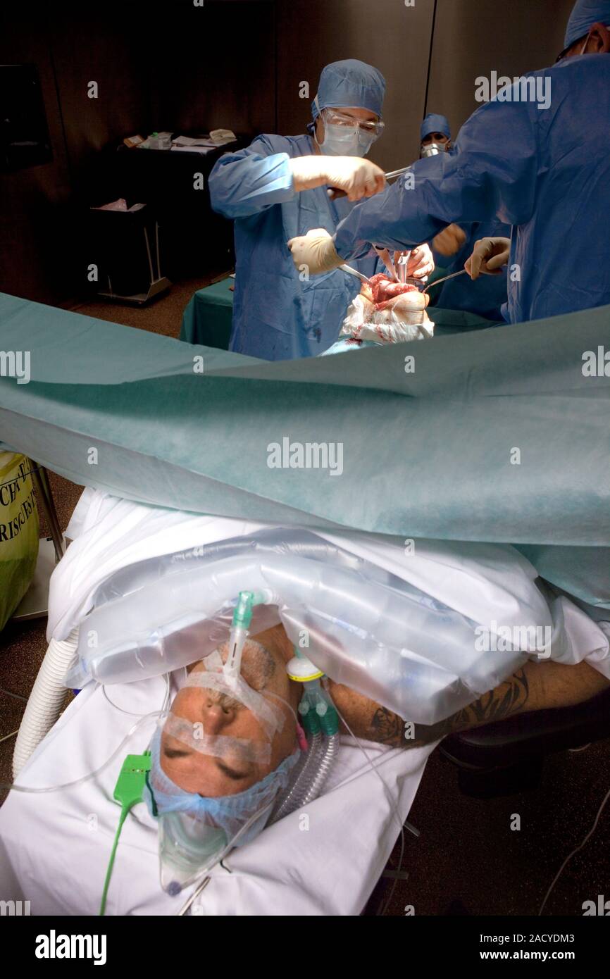 Knee replacement surgery. Surgical team performing a total knee ...