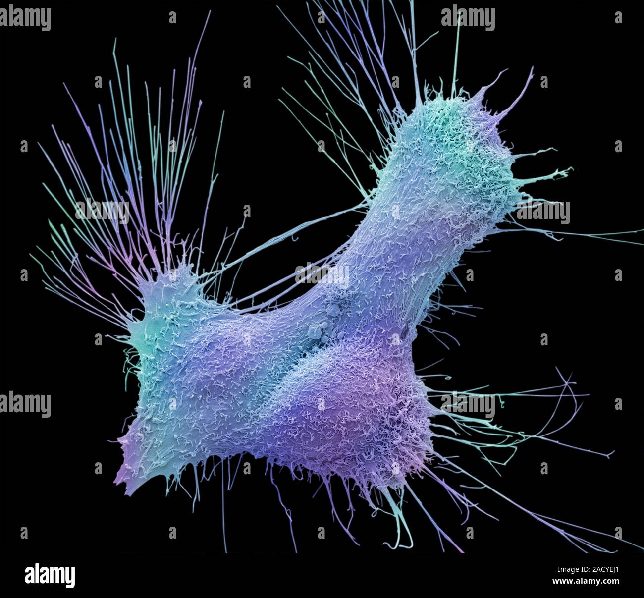 Prostate cancer cells, Coloured scanning electron micrograph (SEM ... Prostate cancer cells, Coloured scanning electron micrograph (SEM ...