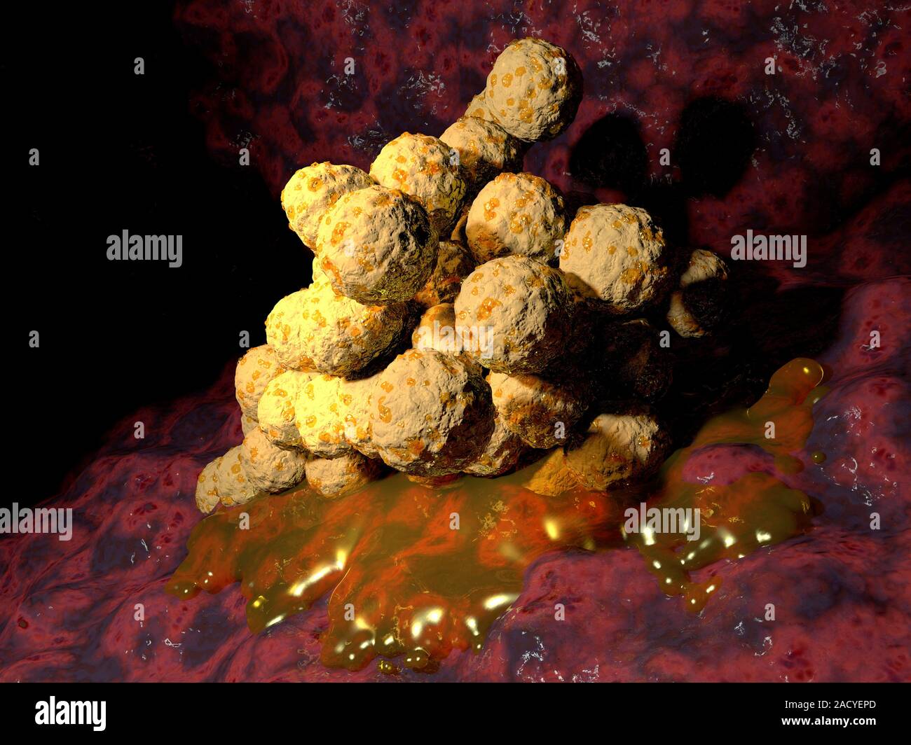 Methicillin-resistant Staphylococcus aureus bacteria (MRSA), computer ...