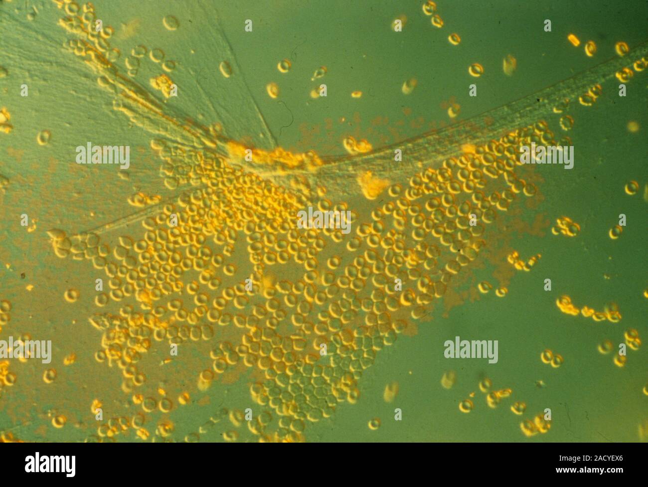 Blood clot. Interference contrast light micrograph of red blood cells ...