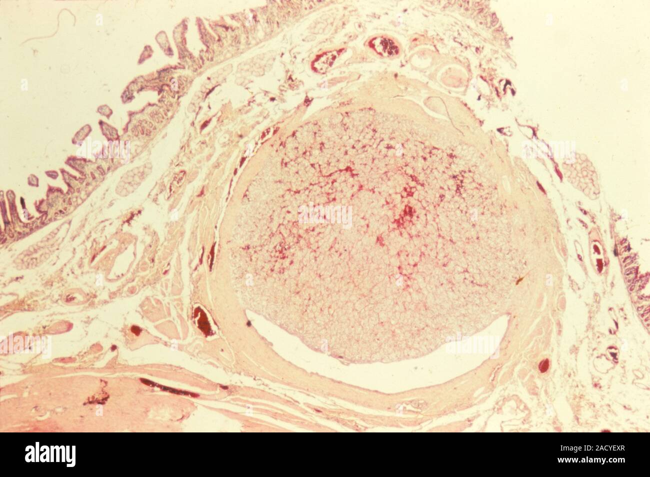 Pancreatic cancer. Light micrograph of a section through a pancreas ...