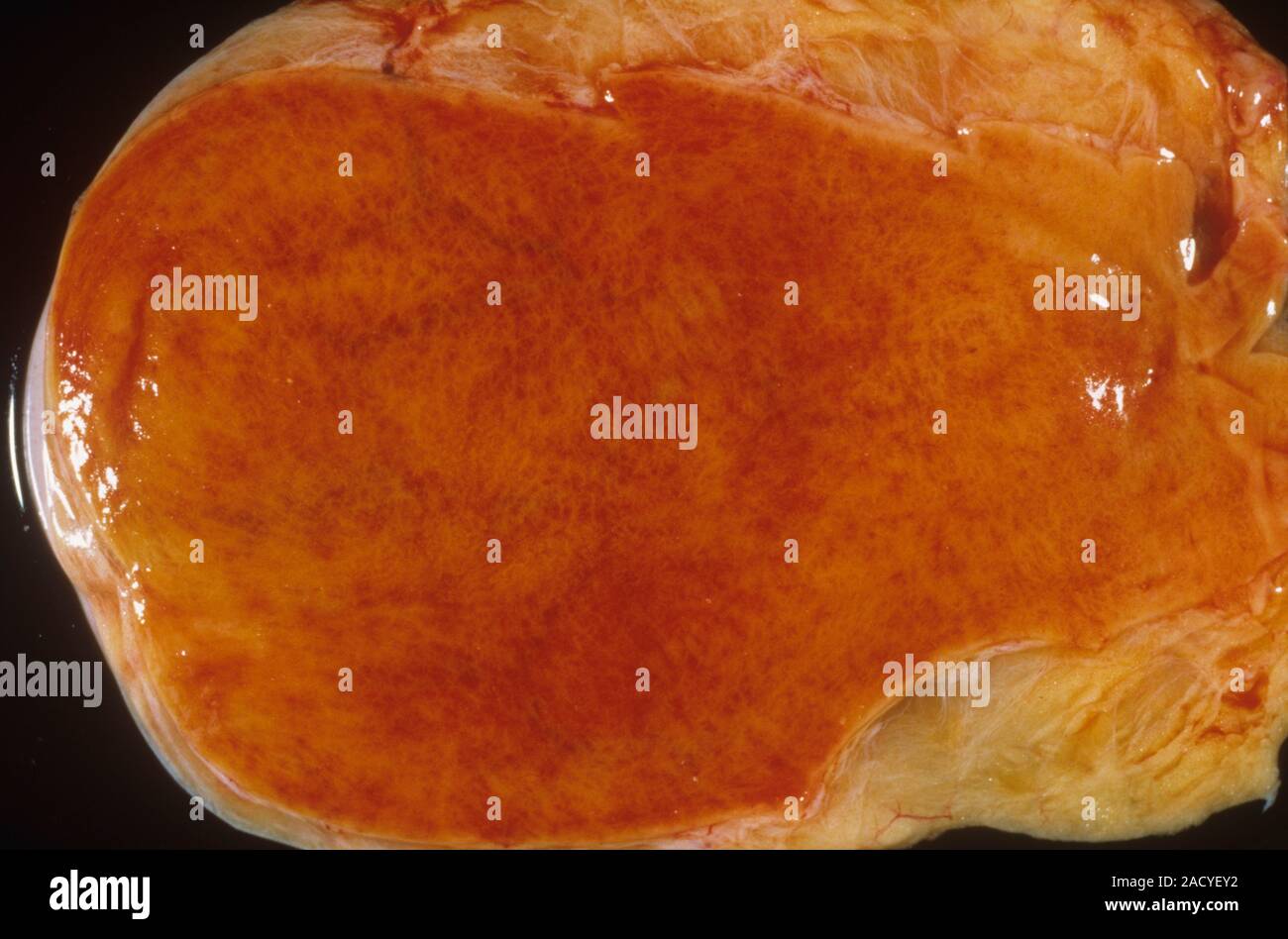Inflamed gallbladder. Close-up of an inflamed section of a gallbladder ...