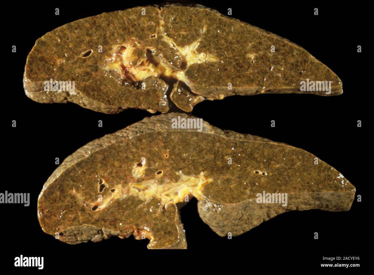 Cholestatic biliary cirrhosis of the liver. Section through a liver ...