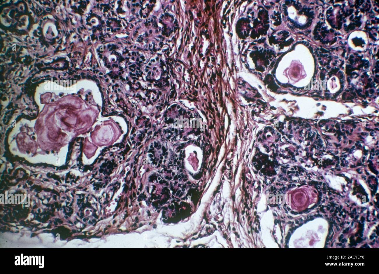 Pancreas in cystic fibrosis. Light micrograph of a section through the ...
