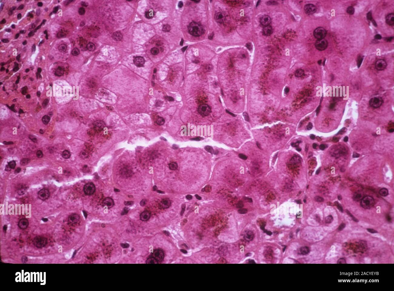Haemochromatosis of the liver. Light micrograph of a section through ...