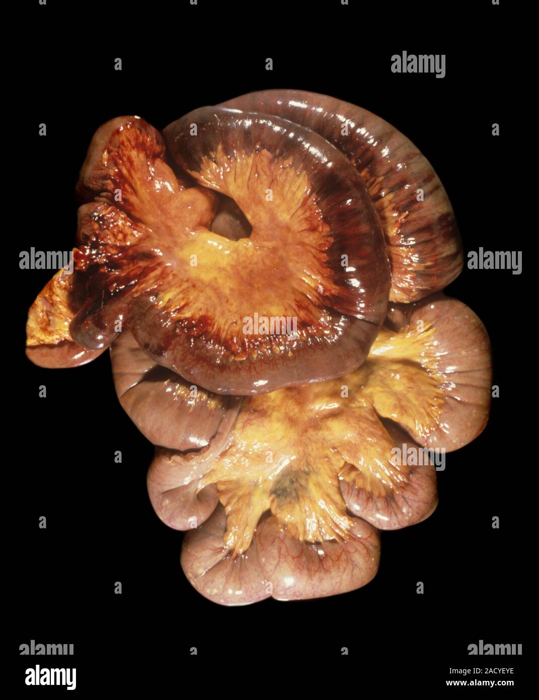 Bowel infarction. Intestines affected by bowel infarction. Infarction ...