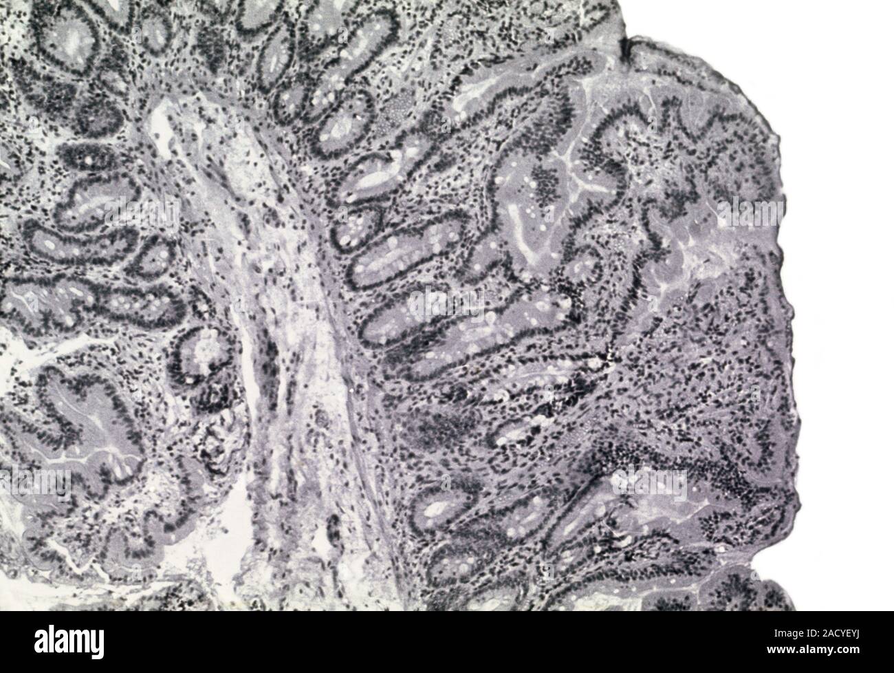 Small intestine in sugar-intolerance. Light micrograph of a section ...