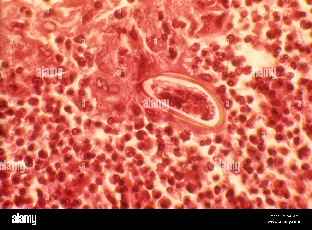 Pinworm infection of the liver. Light micrograph of a section through a ...