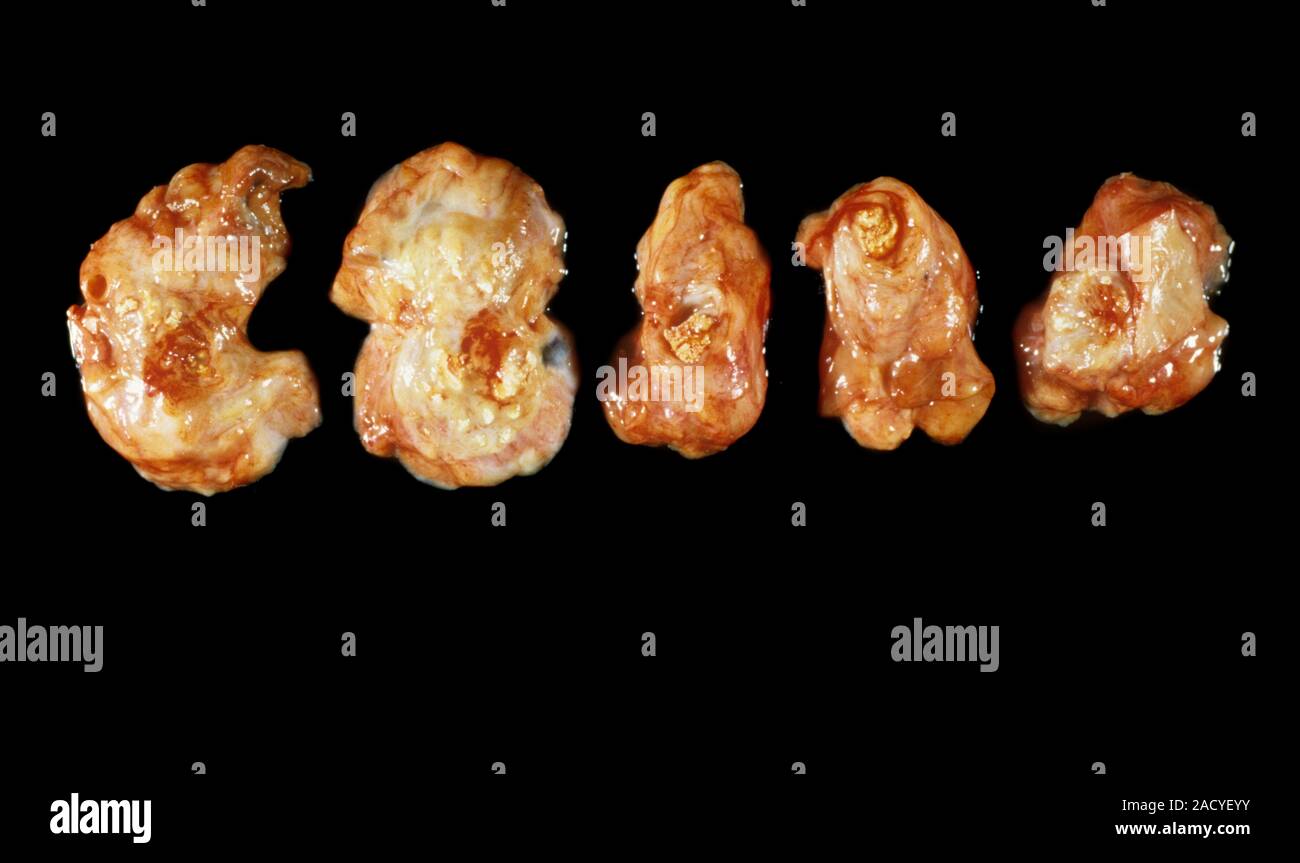 Calcific chronic pancreatitis. Sections of a pancreas affected by ...