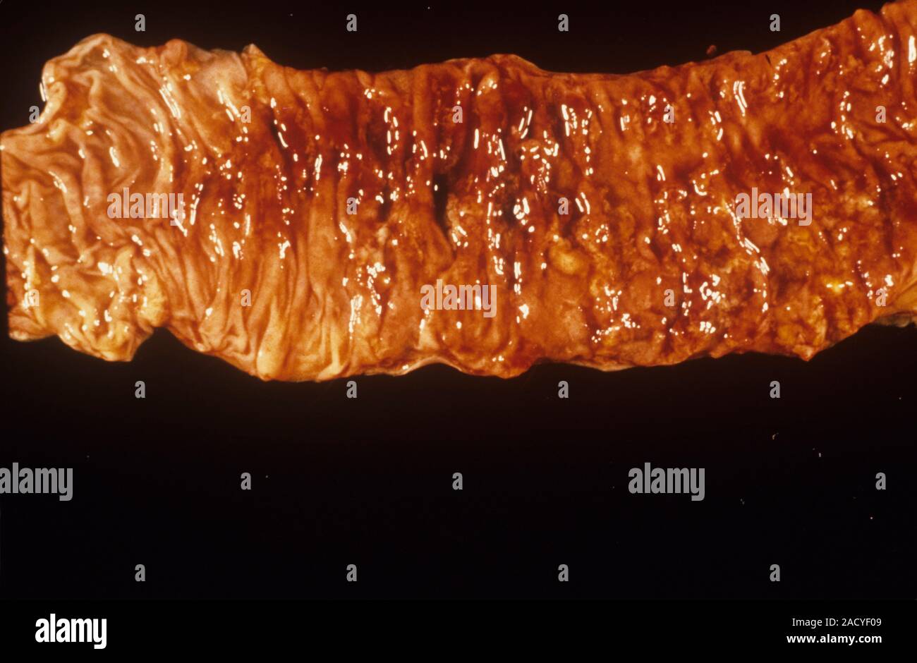 Intestinal ulcer. Small intestine affected by an ulcer. Intestinal ...