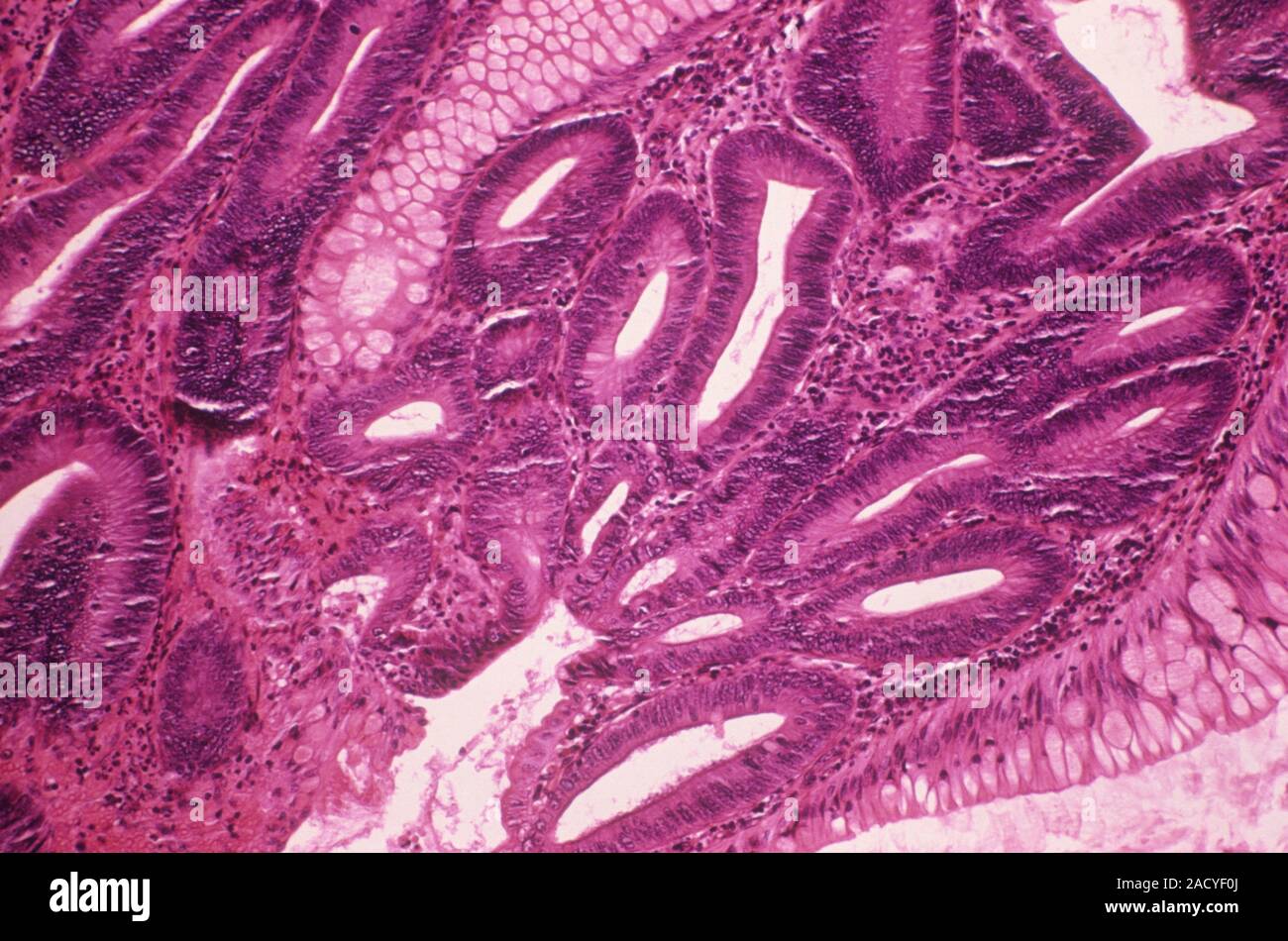 Intestinal Polyp Light Micrograph Of A Section Through An Adenoma In