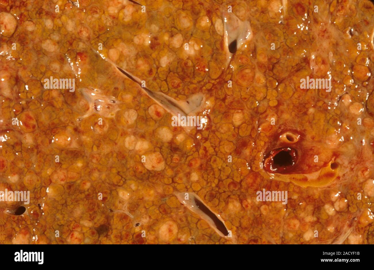 Liver cancer. Close-up of a section through a carcinoma (cancerous ...