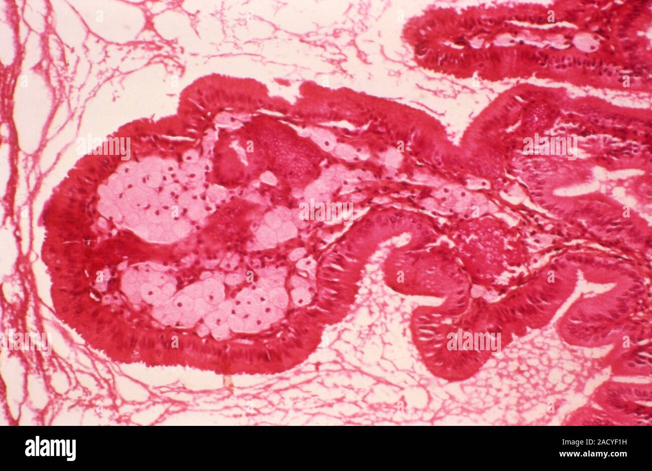 Gallbladder cholesterolosis. Light micrograph of a section through a ...