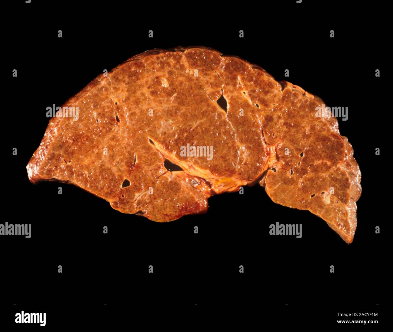 Cirrhotic liver. Section through a liver affected by macronodular (post ...