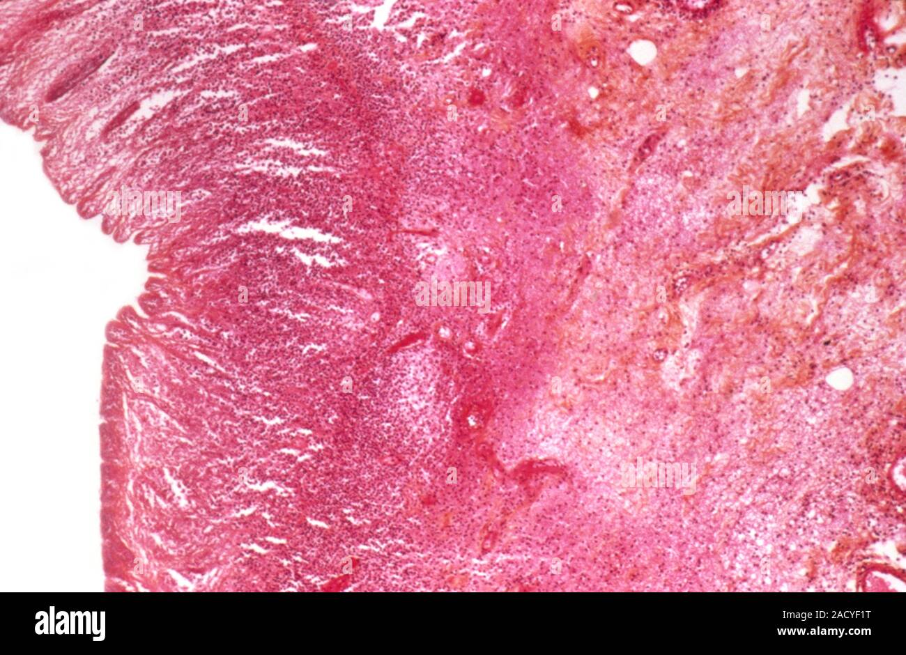 Ischaemic colitis. Light micrograph of a section through a colon (large ...