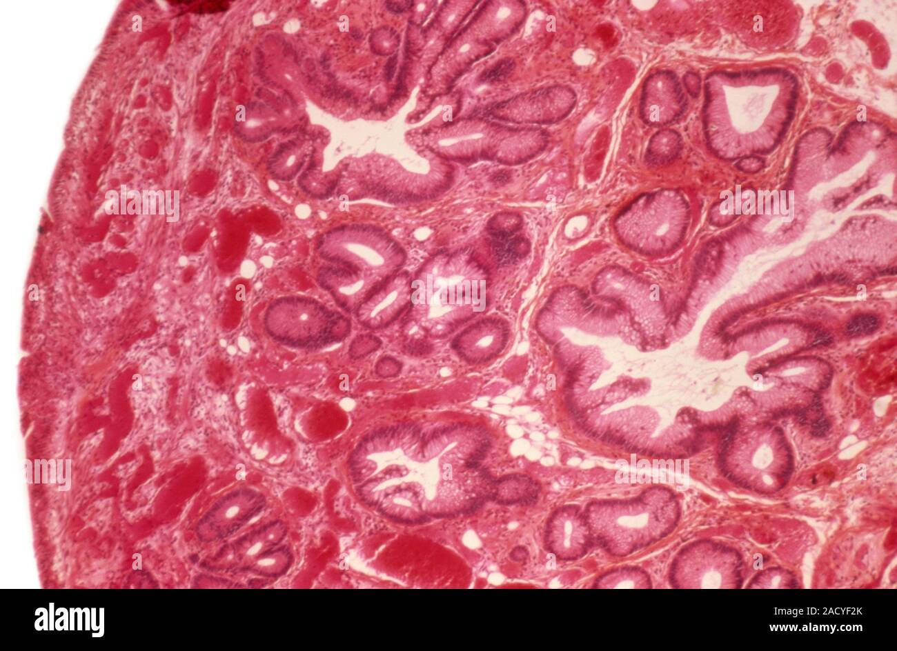 Intestinal hamartoma. Light micrograph of a section through a polypoid ...