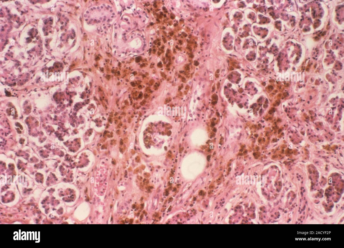 Haemochromatosis of the pancreas. Light micrograph of a section through ...